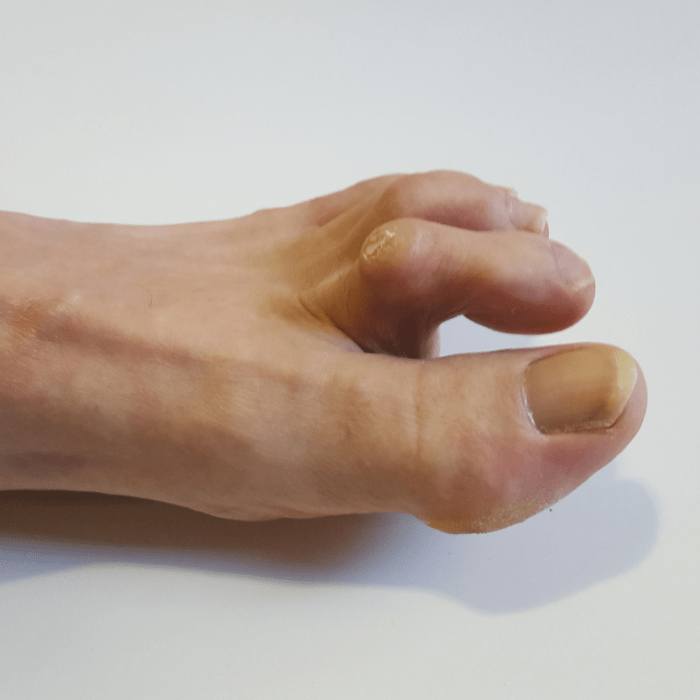 Hammer Toe – Everything You Need To Know – Expert Guidance